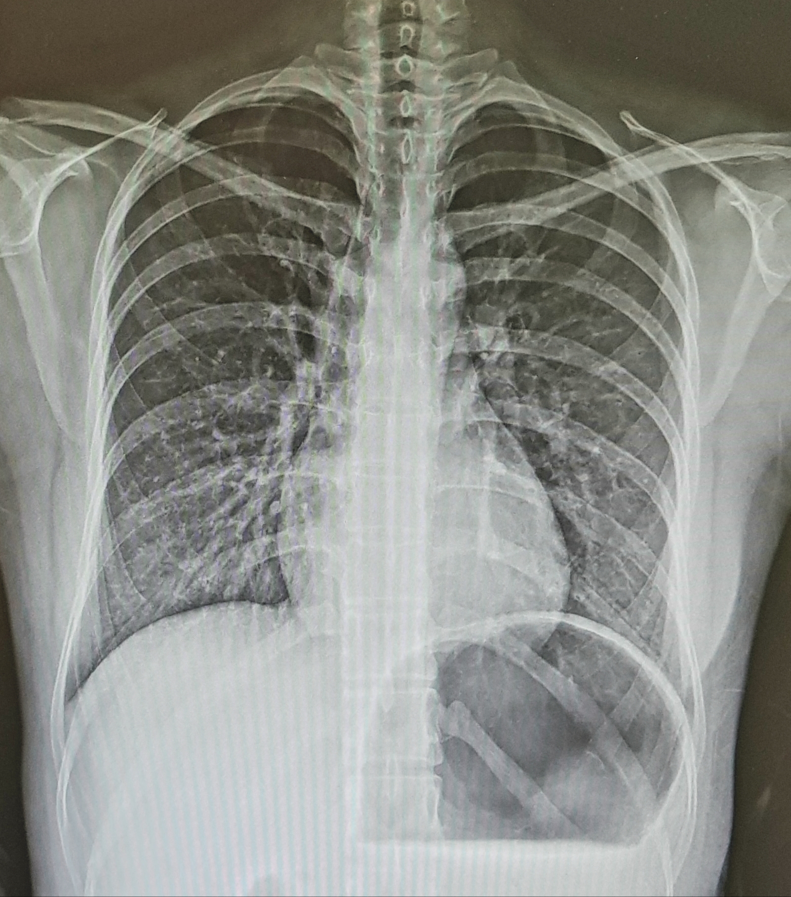 [MRI](영/한) FSE (Fast Spin Echo), TSE(Turbo Spin Echo) / 고속 스핀에코